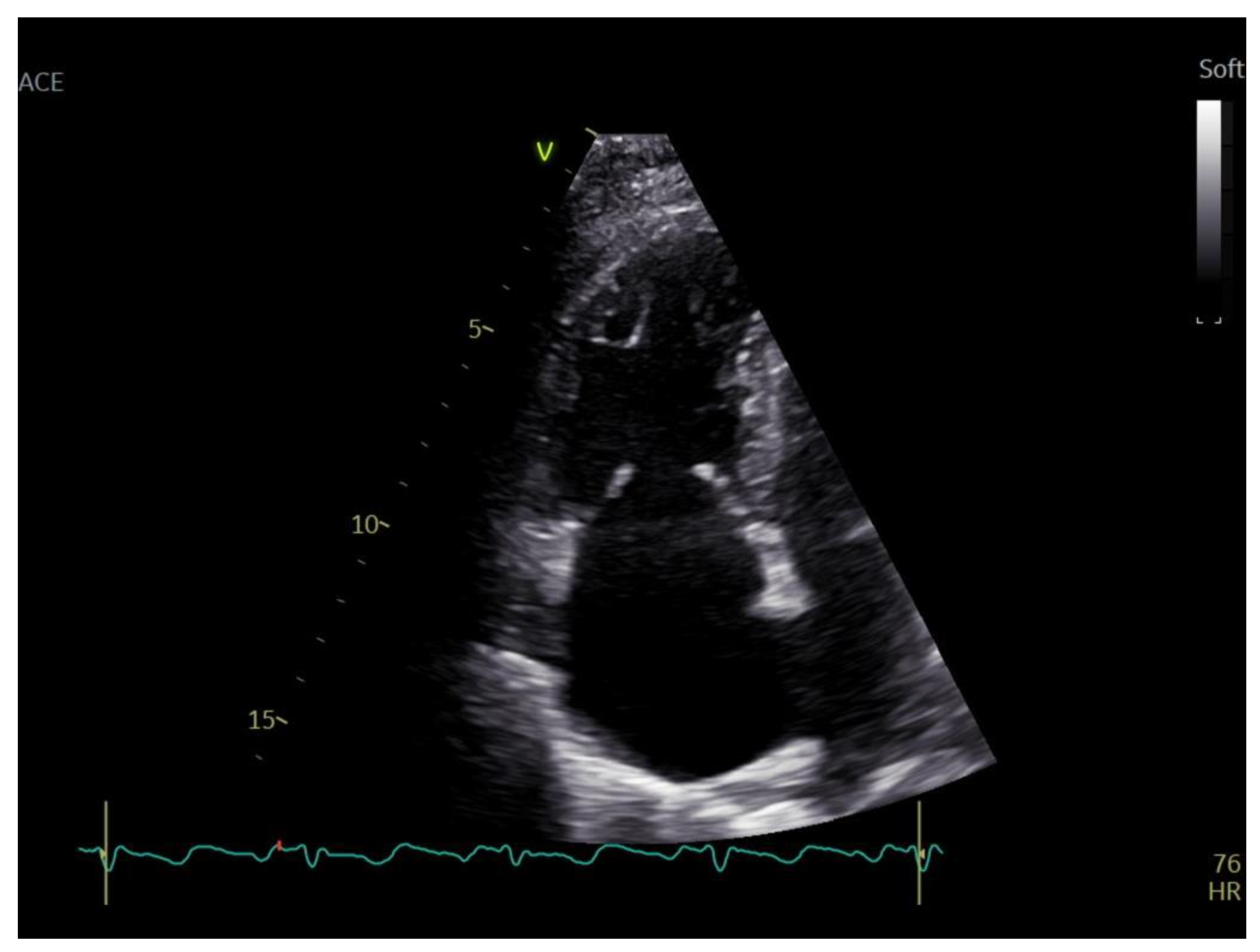 The Role of Echocardiography in the Diagnosis of Cardiac Involvement in ...