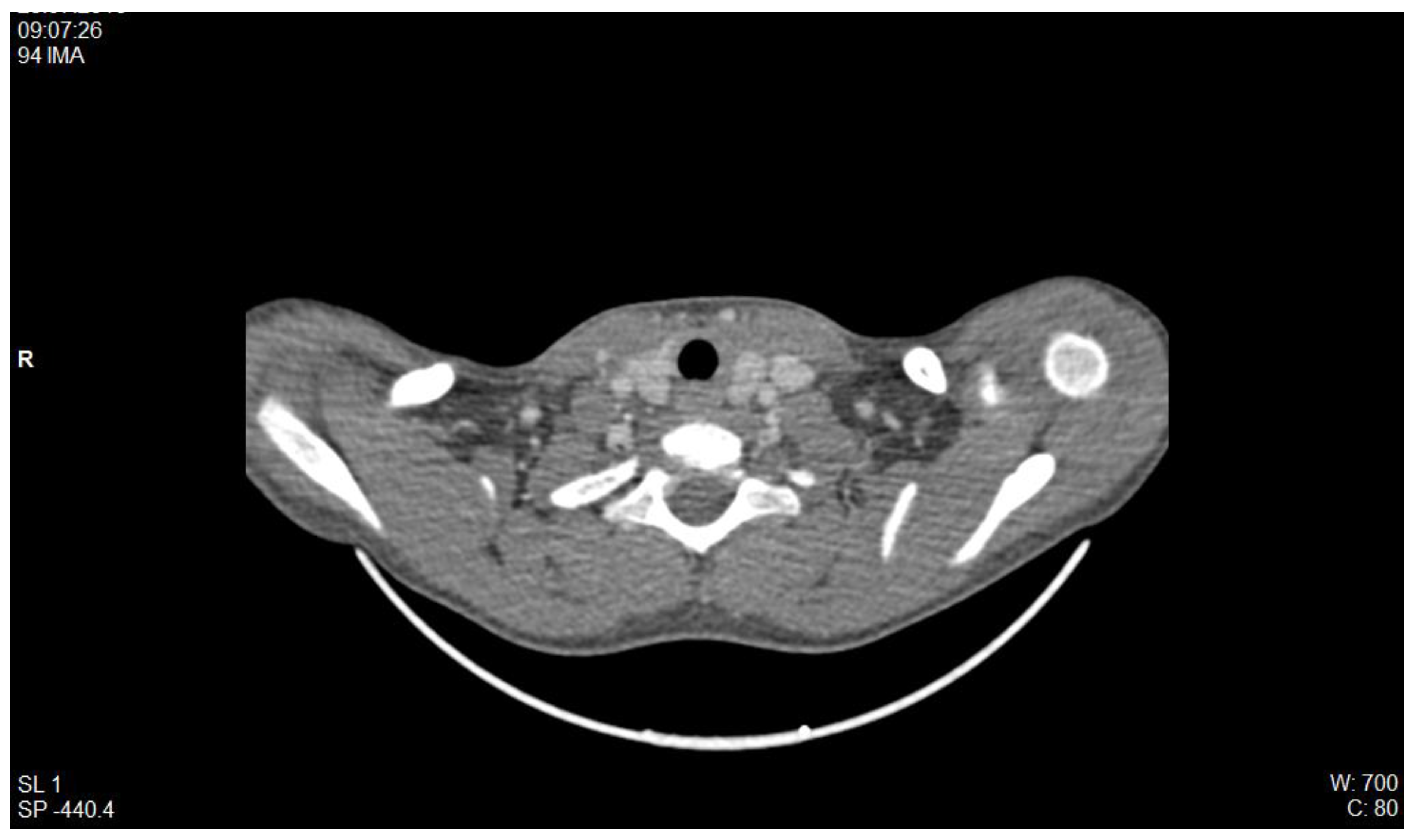 Thrombosis in Chronic Kidney Disease in Children