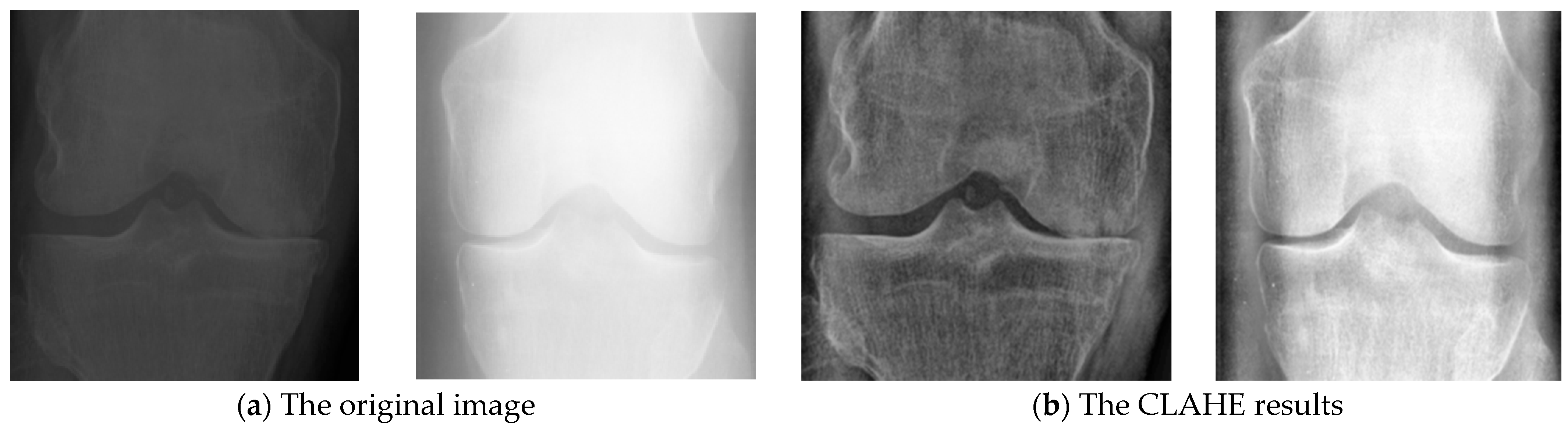 Identifying Severity Grading of Knee Osteoarthritis from X-ray Images ...