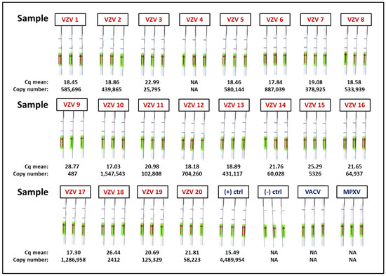 Rapid Detection of the Varicella-Zoster Virus Using a Recombinase-Aided ...