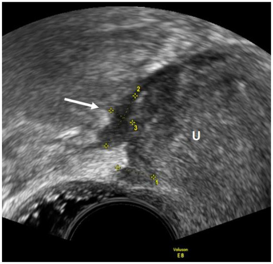 Advances in Imaging for Assessing Pelvic Endometriosis