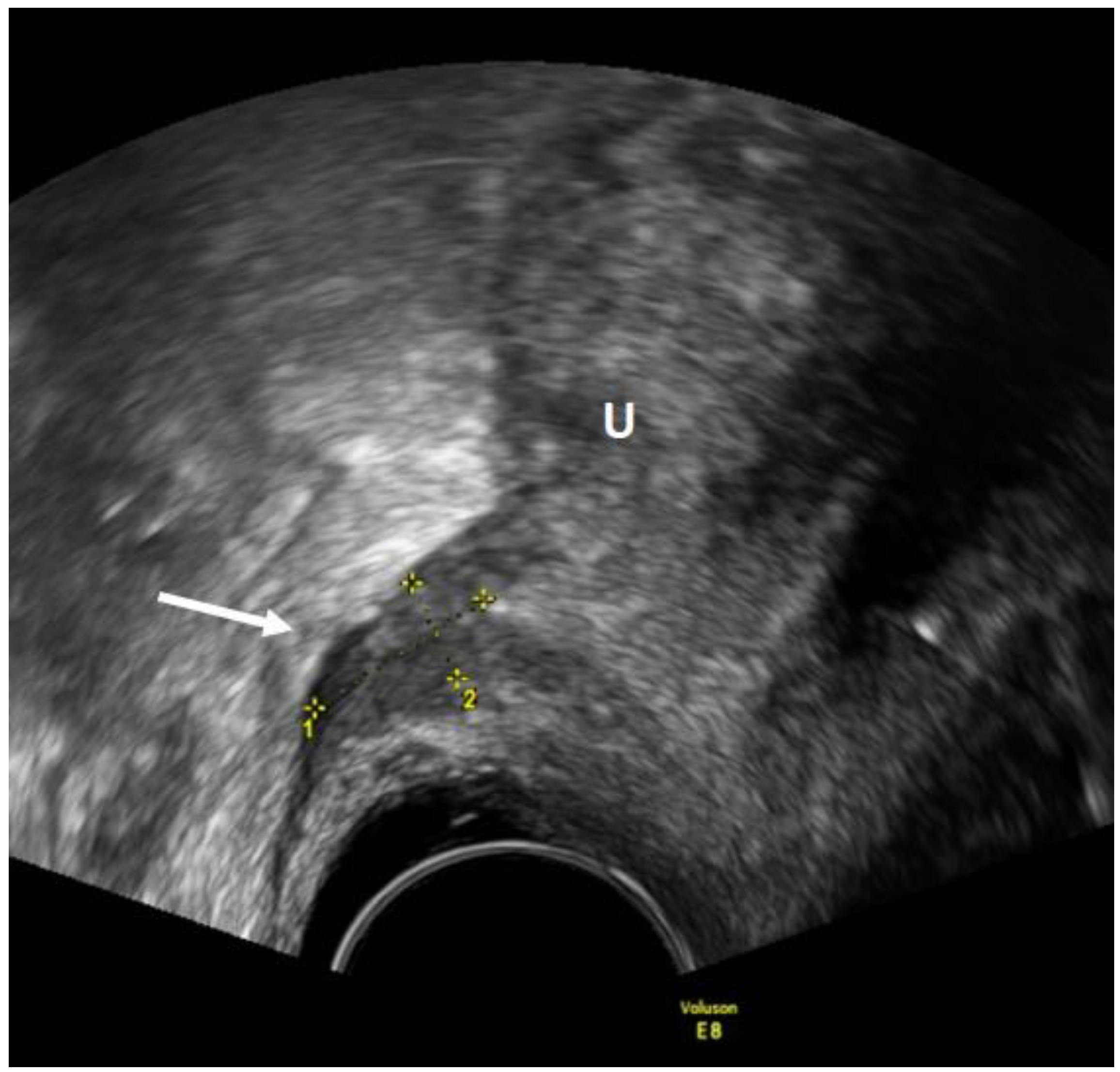 Advances in Imaging for Assessing Pelvic Endometriosis