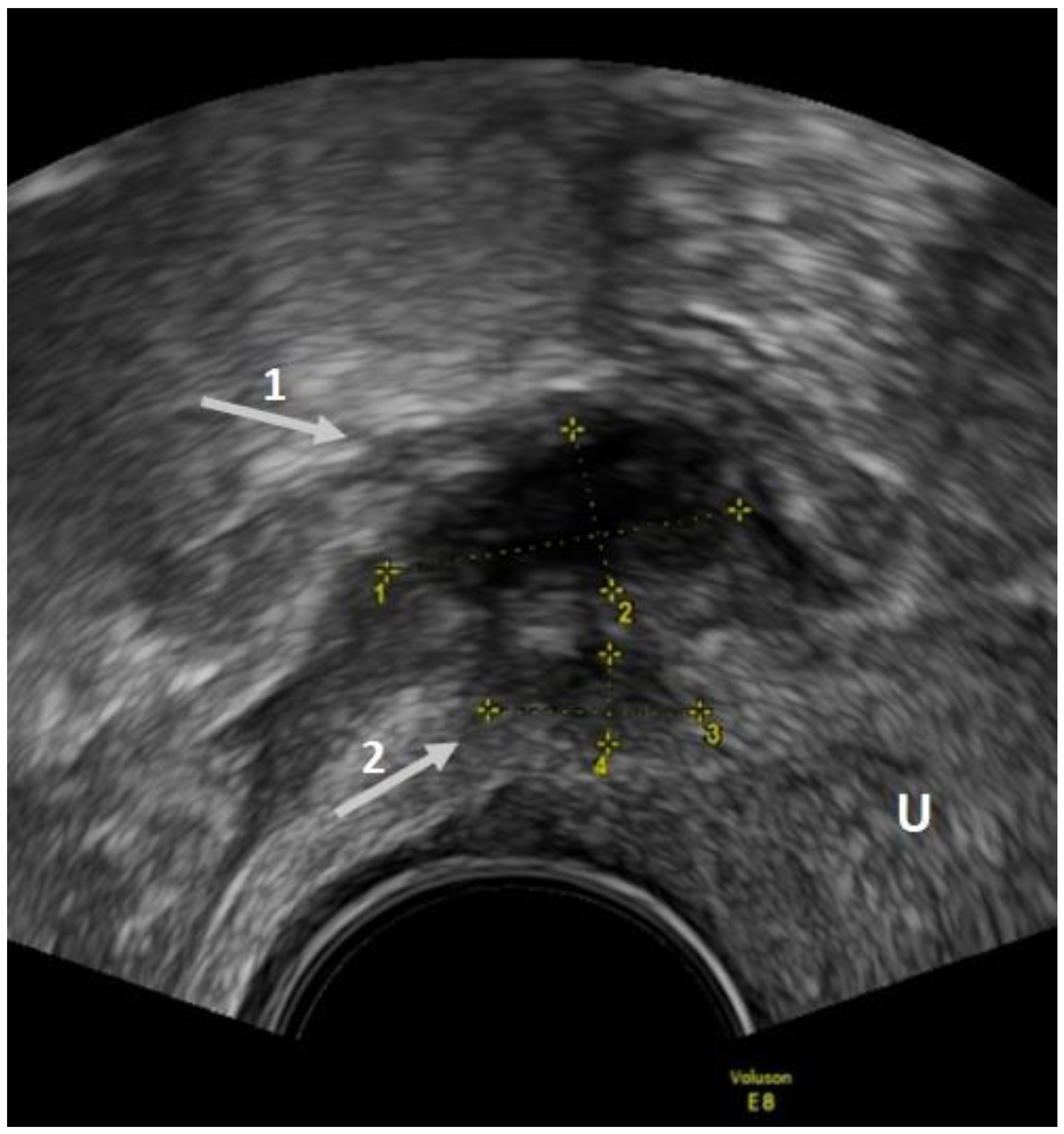 Advances in Imaging for Assessing Pelvic Endometriosis