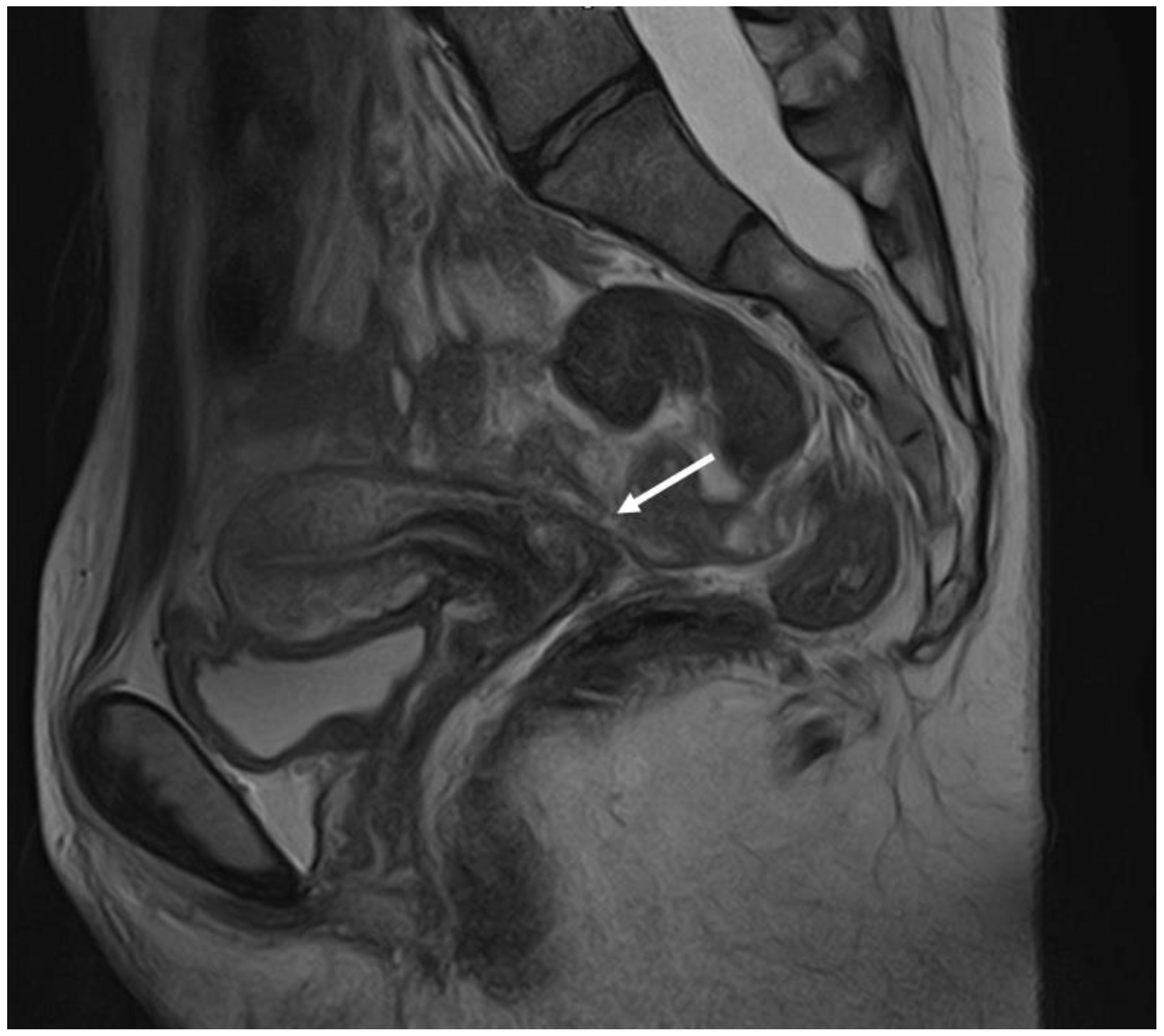 Advances in Imaging for Assessing Pelvic Endometriosis