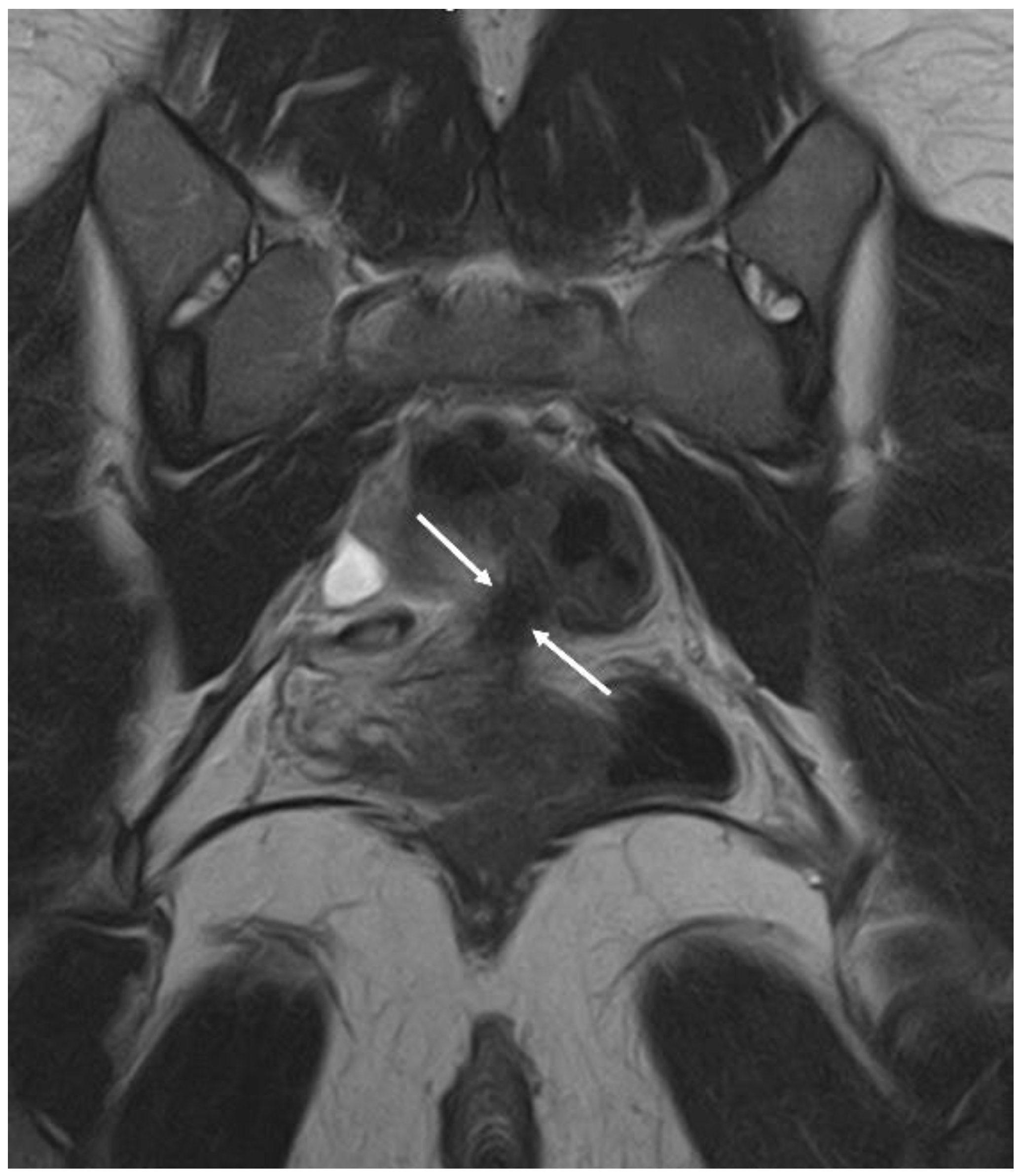 Advances in Imaging for Assessing Pelvic Endometriosis