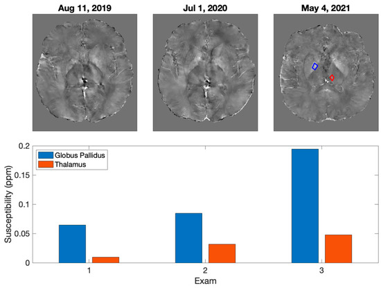 Quantitative Susceptibility Mapping: Translating an Investigative ...