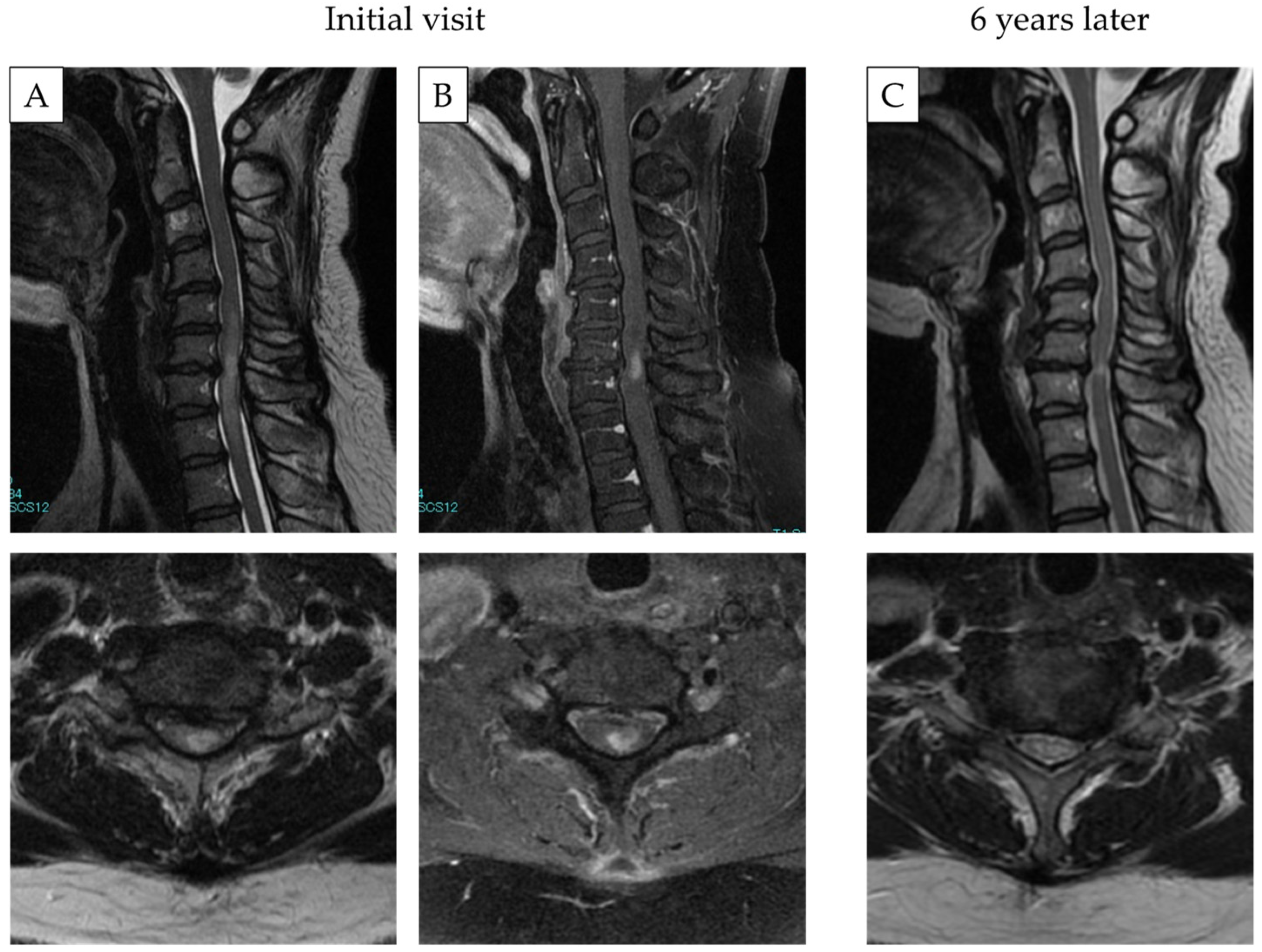 Clinical and Imaging Characteristics of Non-Neoplastic Spinal Lesions ...