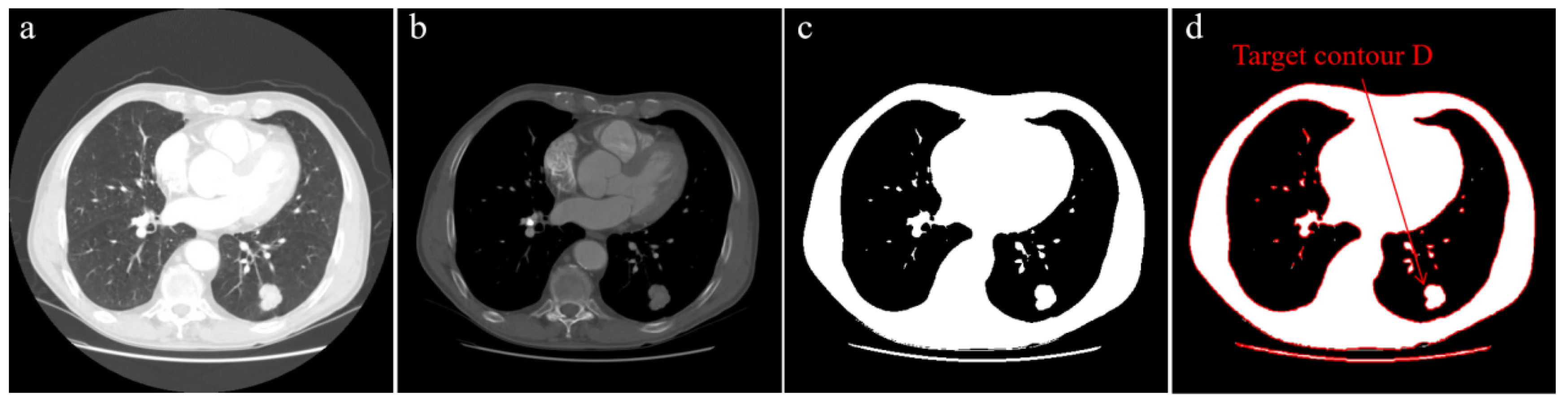 Diagnostics Free Full Text An Automatic Segmentation Method For Lung Tumor Based On Improved