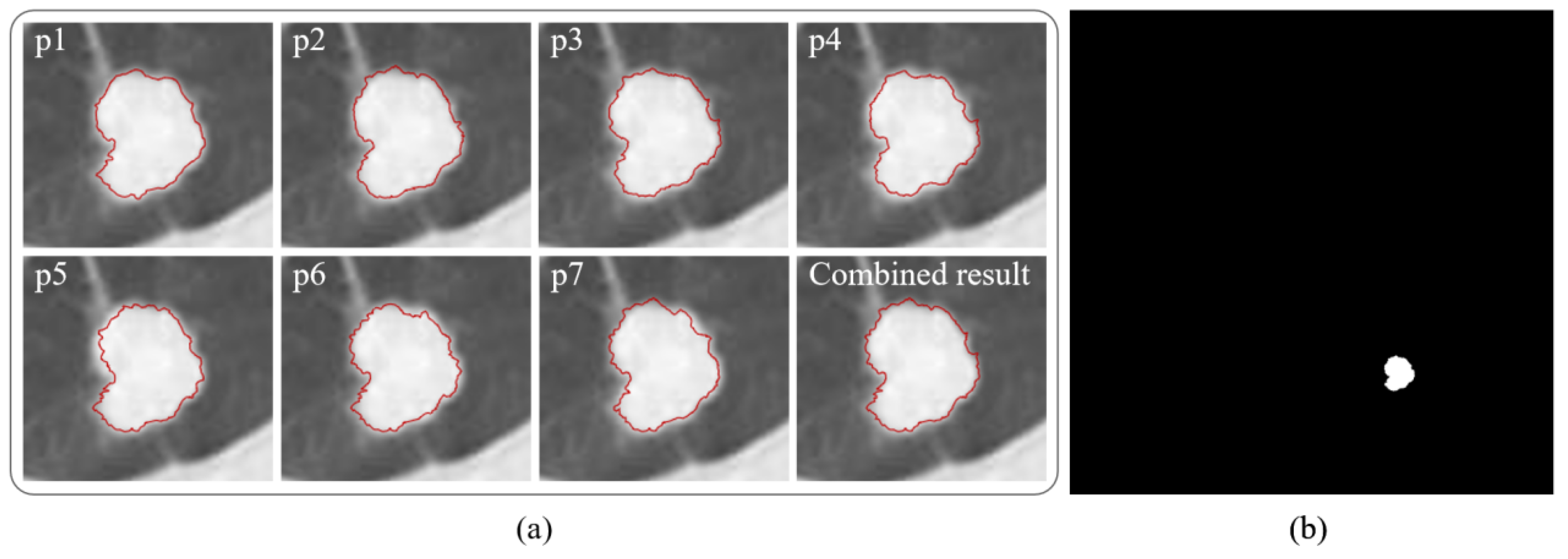 An Automatic Segmentation Method for Lung Tumor Based on Improved Region Growing Algorithm