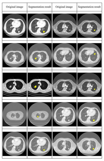 An Automatic Segmentation Method for Lung Tumor Based on Improved ...