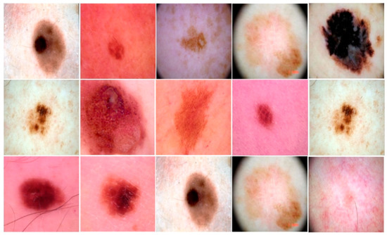 Skin Lesion Detection Using Hand-Crafted and DL-Based Features Fusion ...