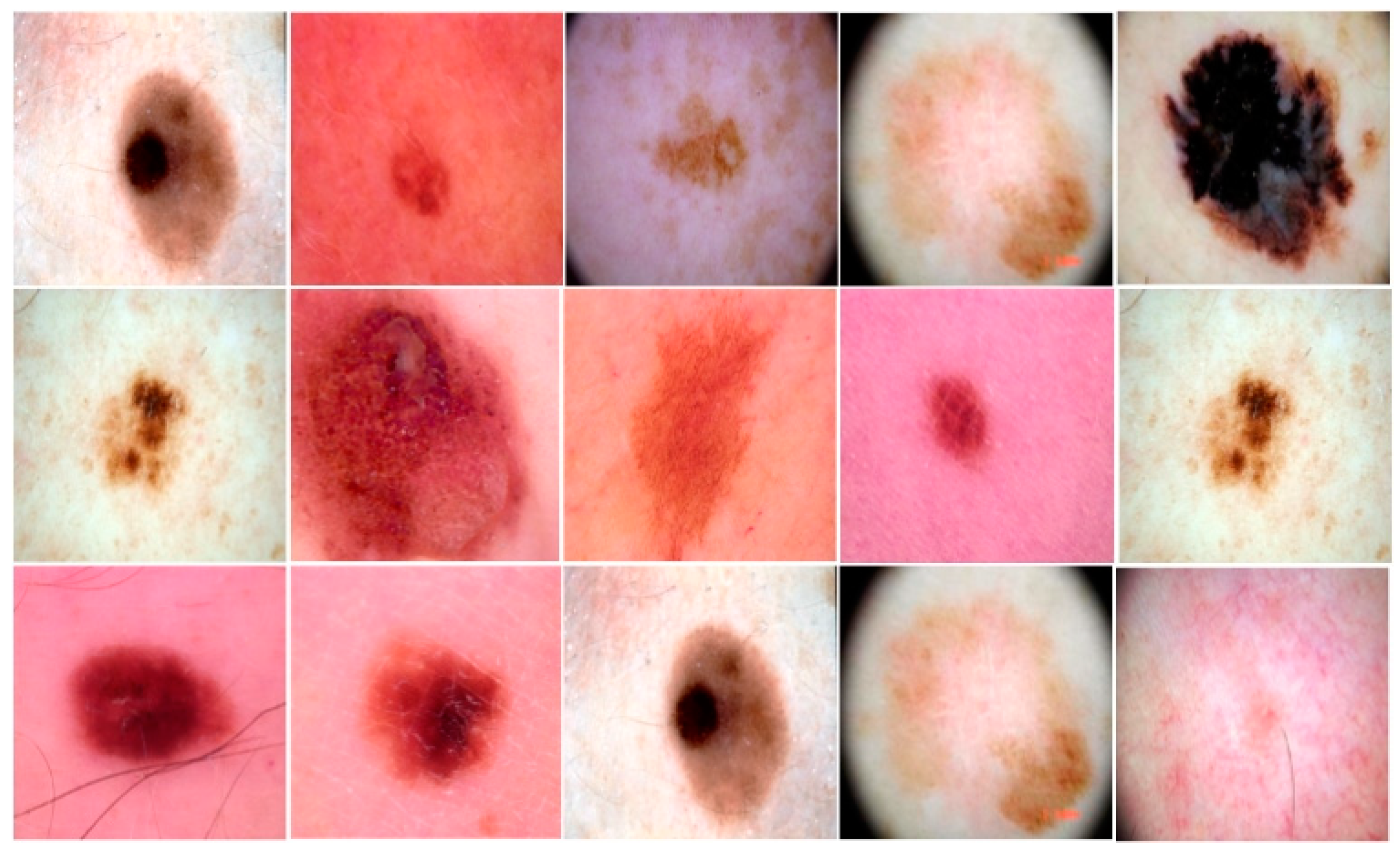 Skin Lesion Detection Using Hand-Crafted and DL-Based Features Fusion ...