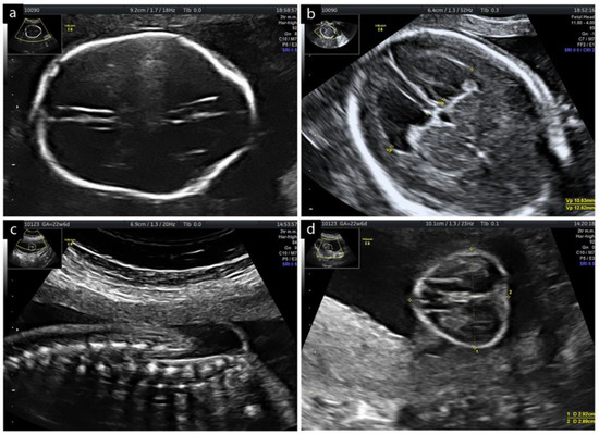 Fetoscopic Myelomeningocele Repair with Complete Release of the ...