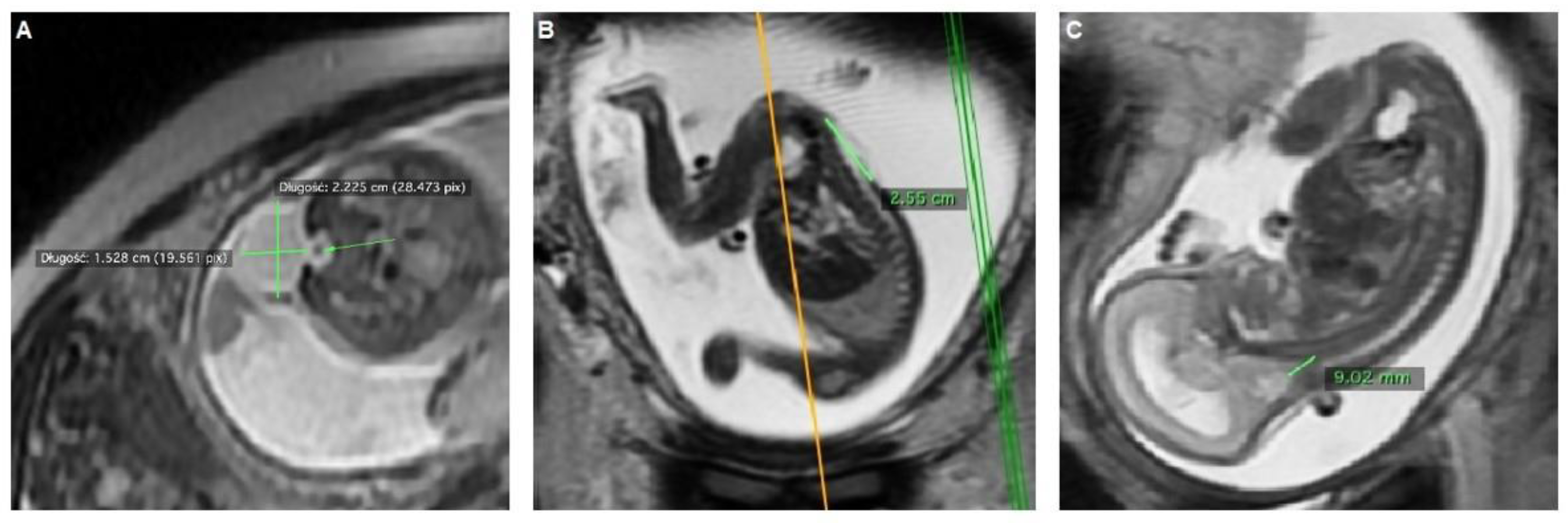 Fetoscopic Myelomeningocele Repair with Complete Release of the ...