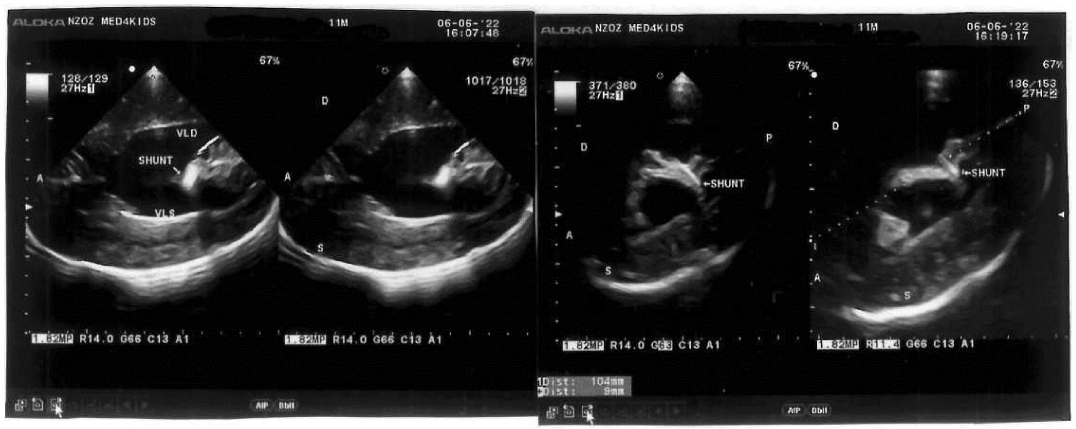 Fetoscopic Myelomeningocele Repair with Complete Release of the ...
