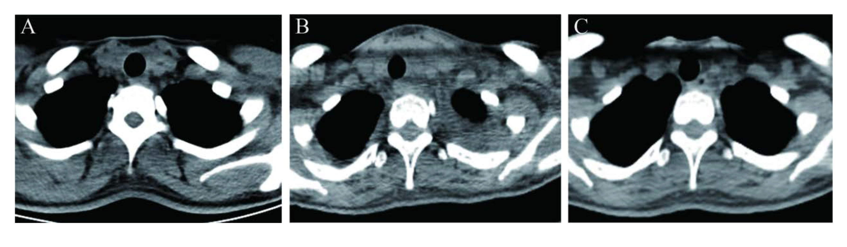 Diagnosis and Treatment of Acute Pleural Effusion following Radioiodine ...