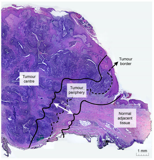 Regulatory T Cells but Not Tumour-Infiltrating Lymphocytes Correlate ...