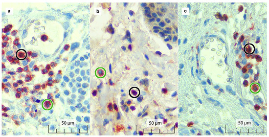 Regulatory T Cells but Not Tumour-Infiltrating Lymphocytes Correlate ...