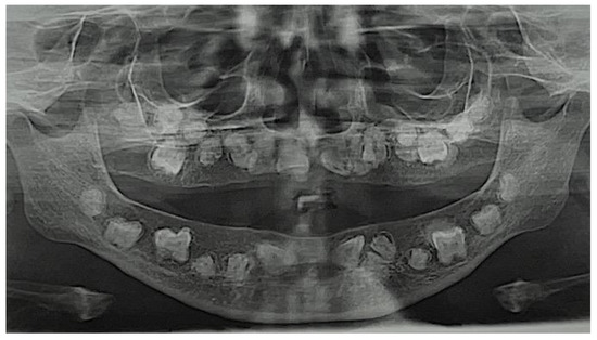 Anodontia Radiograph