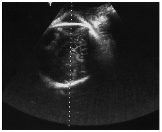 Asynclitism and Its Ultrasonographic Rediscovery in Labor Room to Date ...