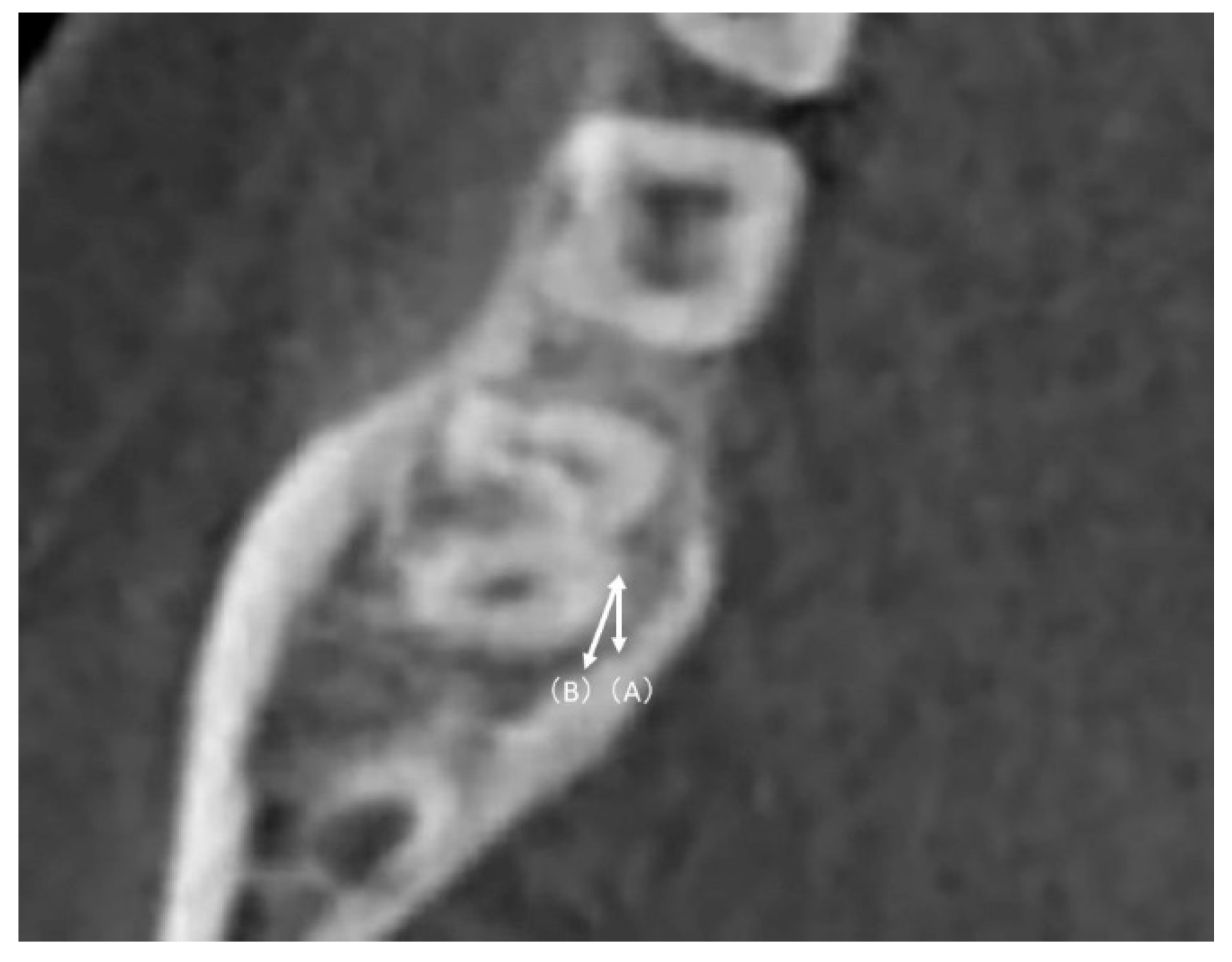Association of Mandibular Posterior Anatomic Limit with Skeletal ...