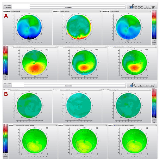 Enhanced Diagnostics for Corneal Ectatic Diseases: The Whats, the Whys ...