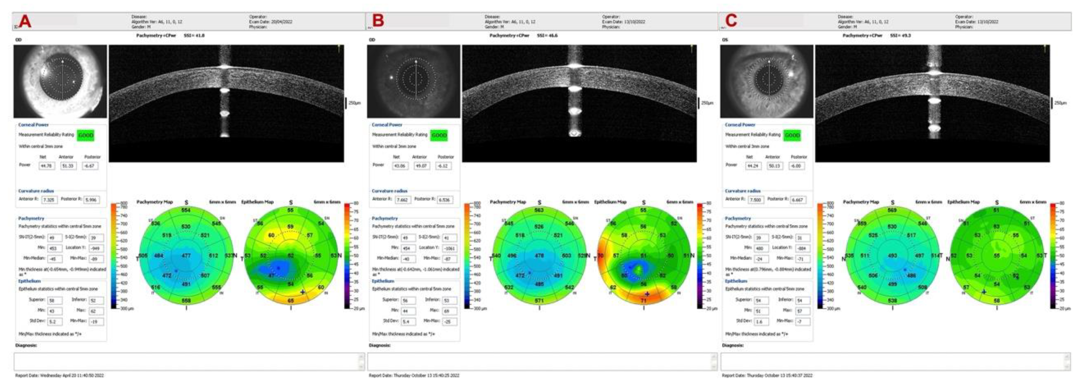 Enhanced Diagnostics for Corneal Ectatic Diseases: The Whats, the Whys ...