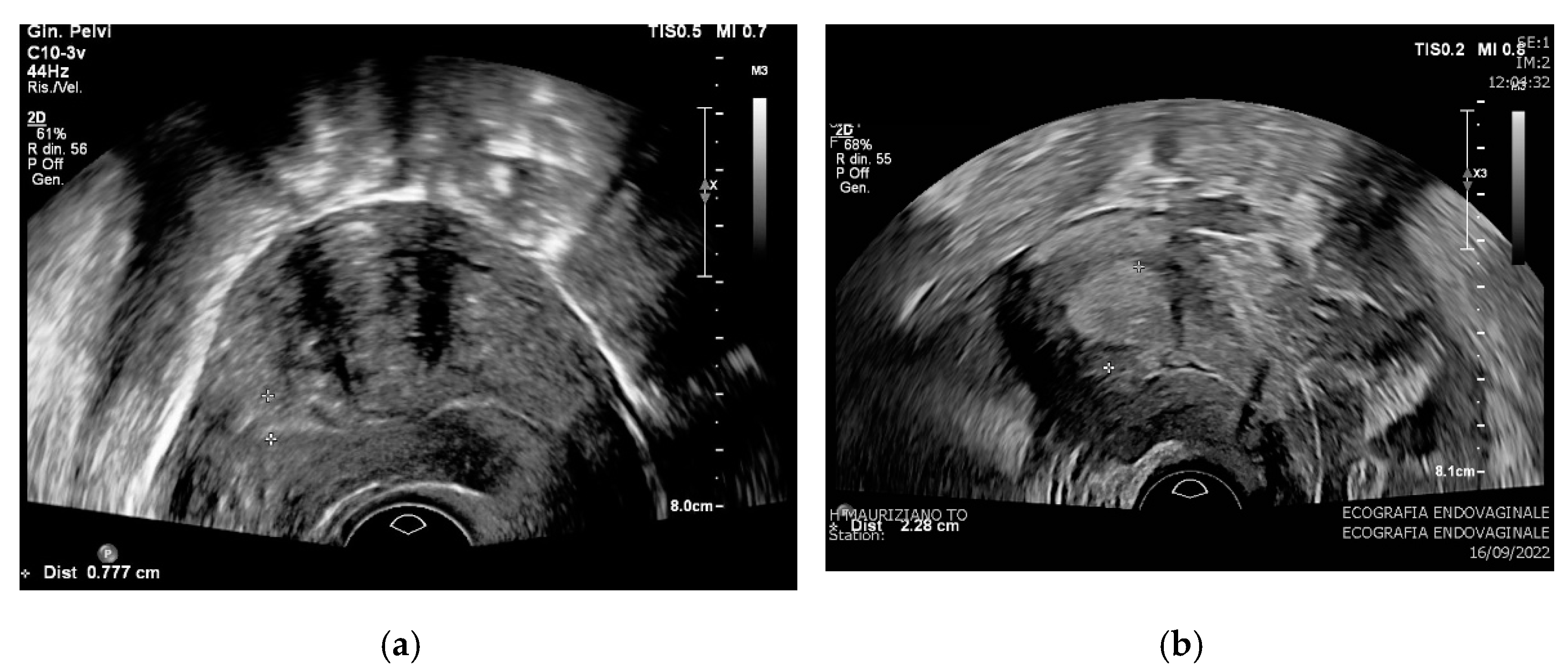 Clinical, Sonographic, and Hysteroscopic Features of Endometrial ...