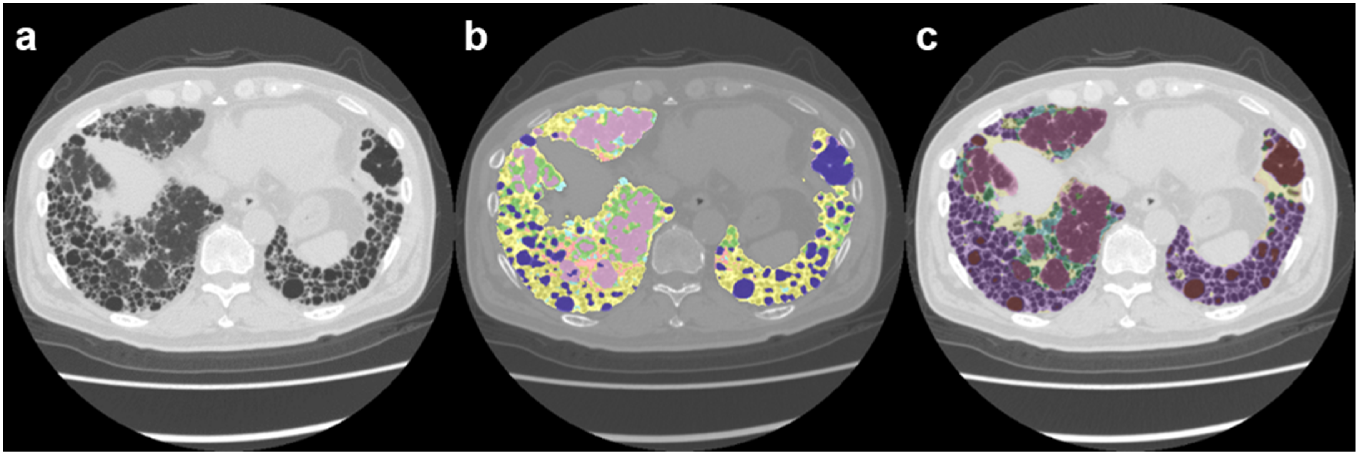 Effects of Automatic Deep-Learning-Based Lung Analysis on ...