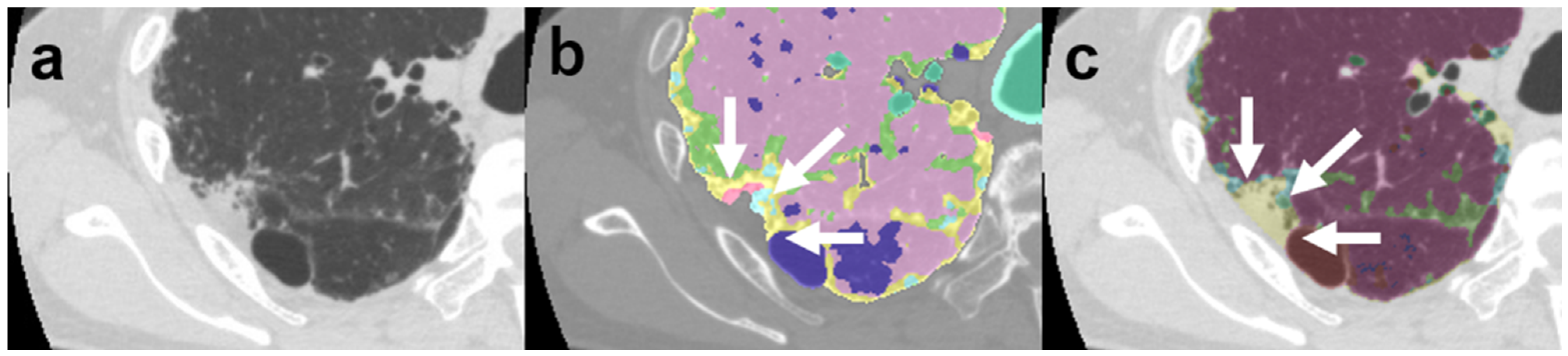 Effects of Automatic Deep-Learning-Based Lung Analysis on ...