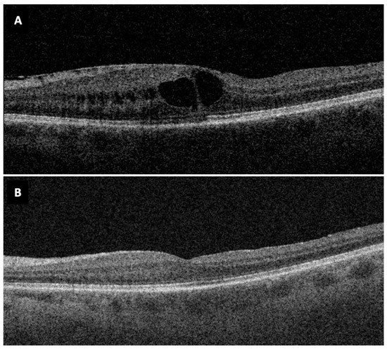 Functional and Anatomical Outcomes of Pars Plana Vitrectomy for ...