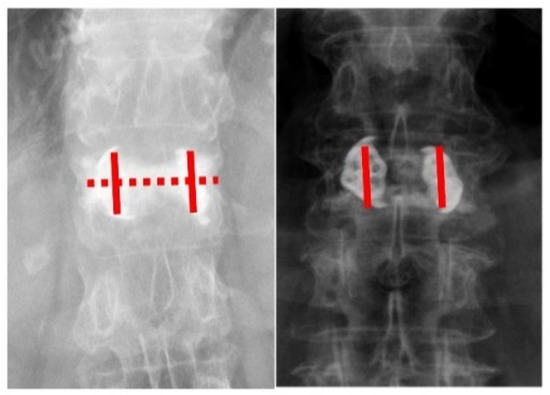 “Double Cross Sign” Could Be an Indicator of an Adequate Amount of Bone ...