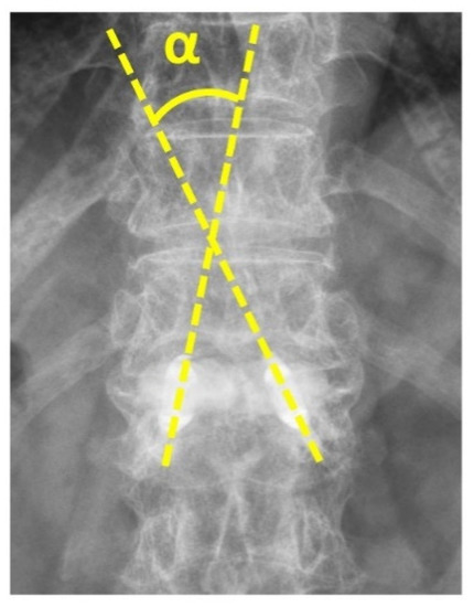 “Double Cross Sign” Could Be an Indicator of an Adequate Amount of Bone ...