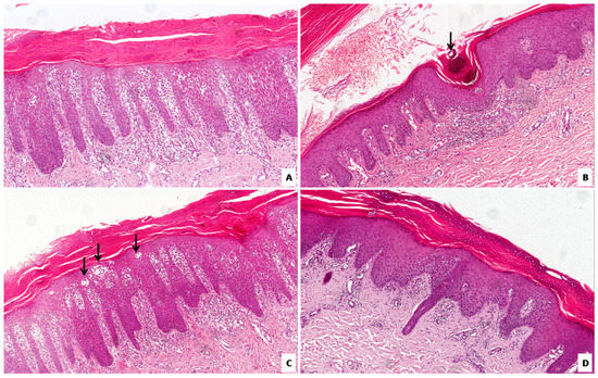 Diagnostics Free Full Text Palmoplantar Psoriasis A Clinico