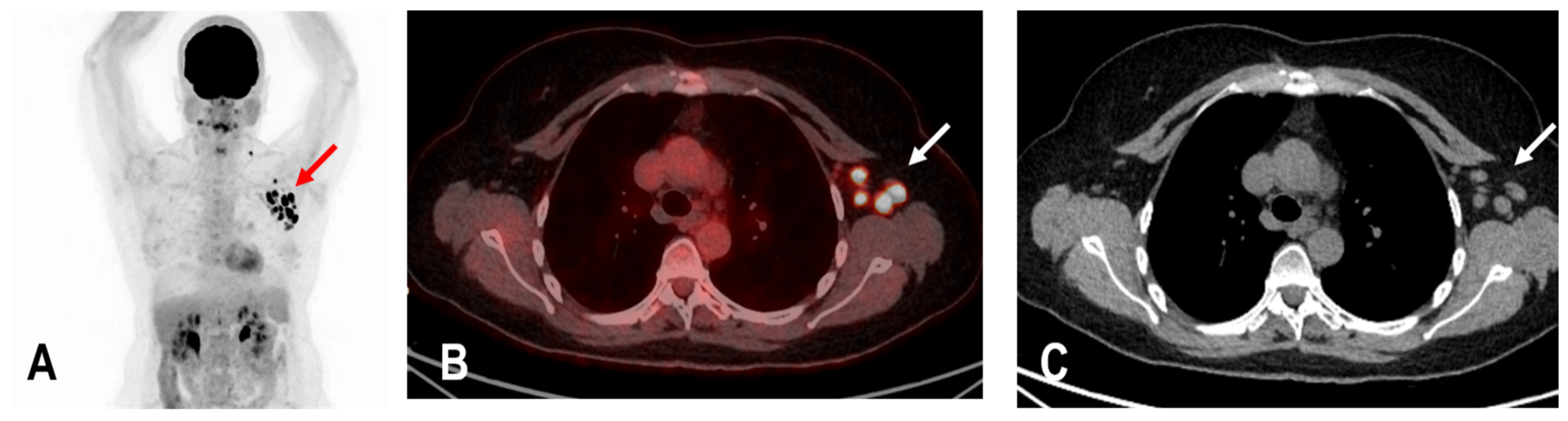 Hypermetabolic Ipsilateral Supraclavicular and Axillary Lymphadenopathy ...