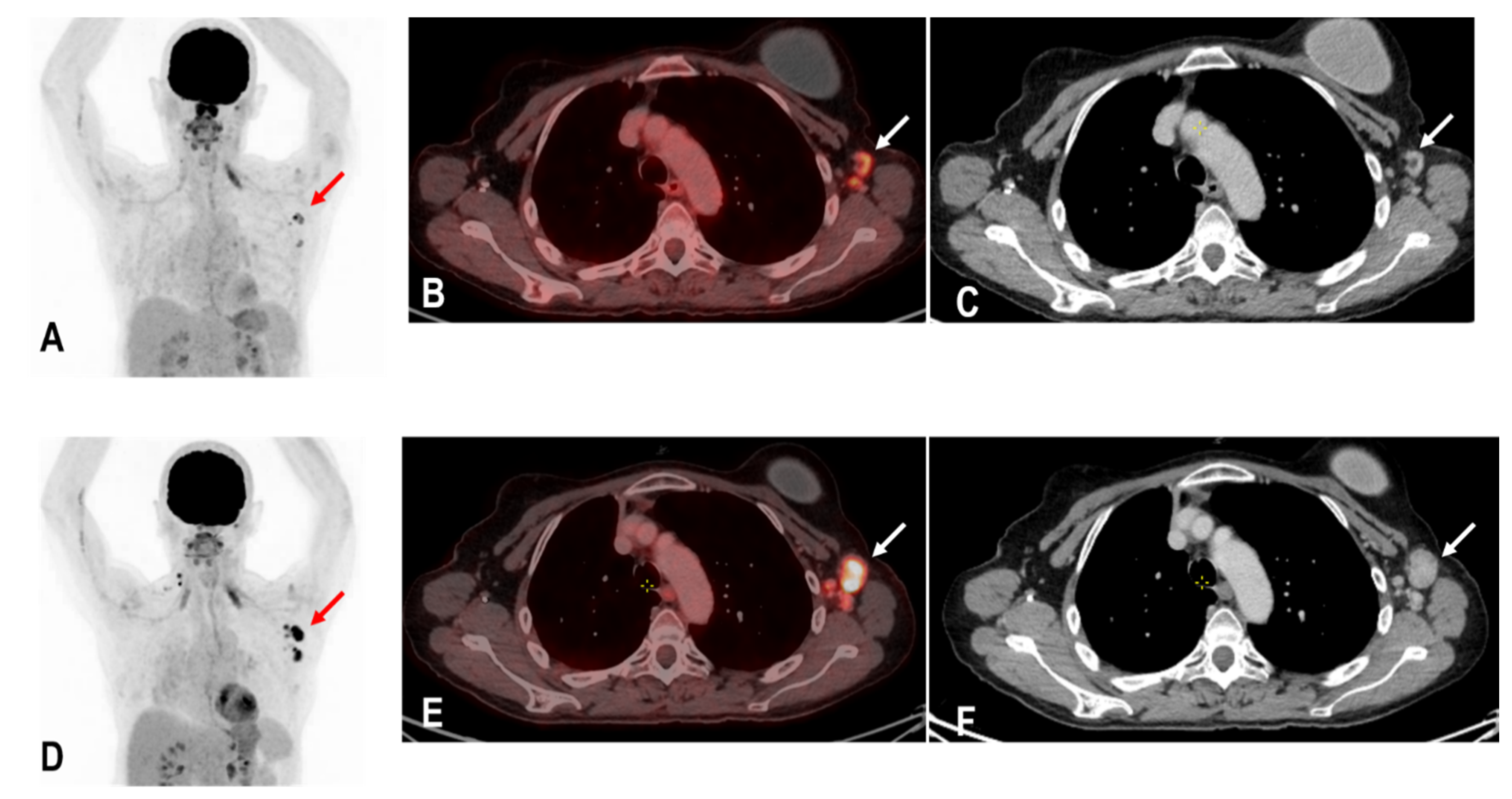 Hypermetabolic Ipsilateral Supraclavicular and Axillary Lymphadenopathy ...