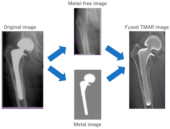 Advances in Bone Joint Imaging-Metal Artifact Reduction