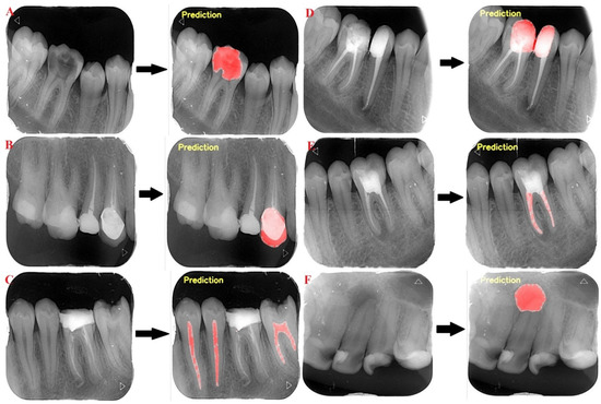 Automatic Feature Segmentation in Dental Periapical Radiographs