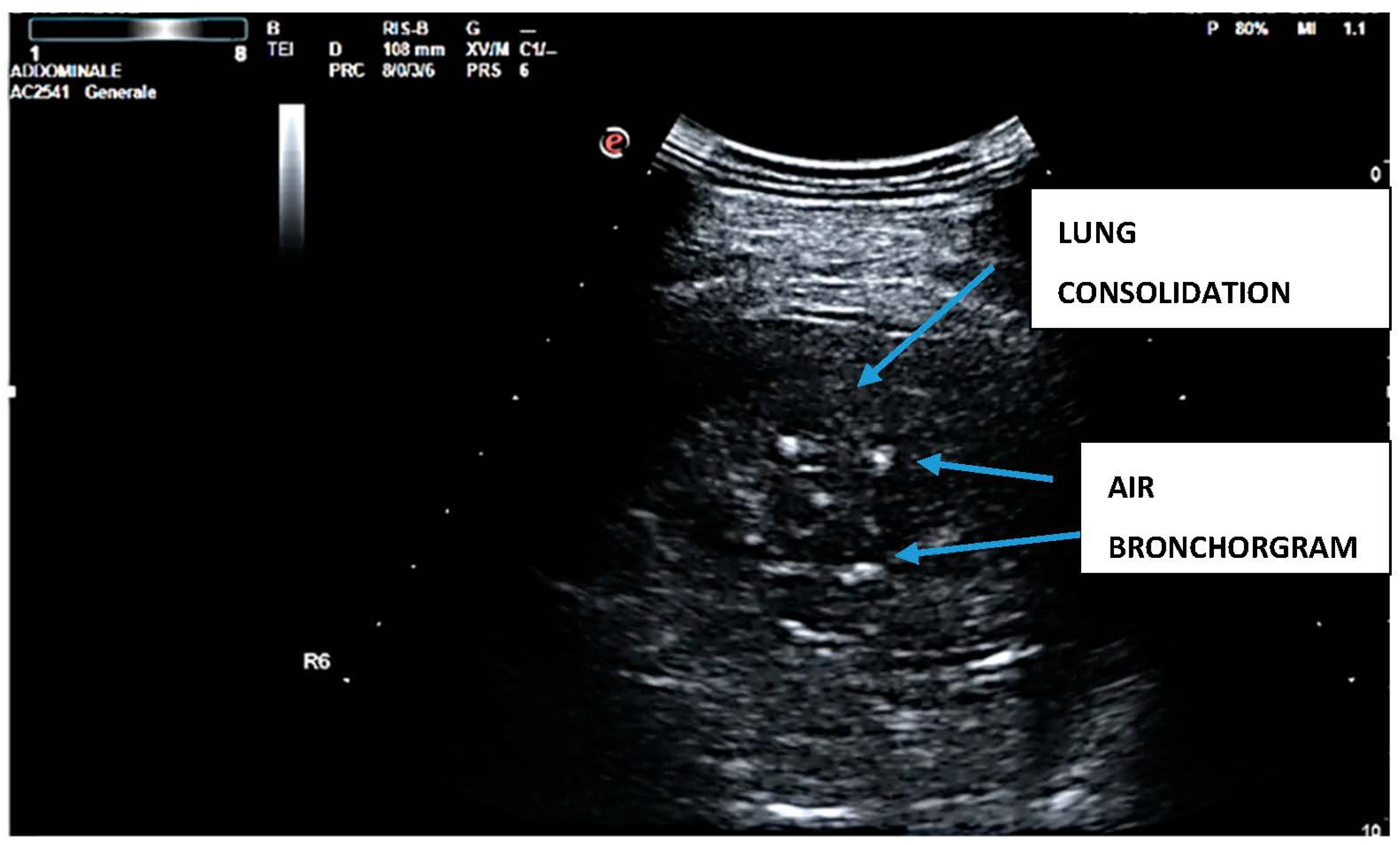 Lung Ultrasound in Coronary Care Unit, an Important Diagnostic Tool for ...