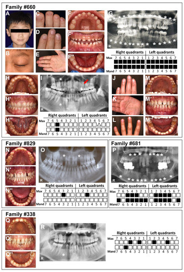 Dose Dependence Effect in Biallelic WNT10A Variant-Associated Tooth ...