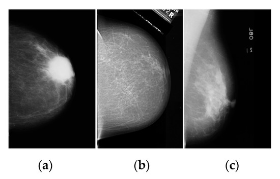 Breast Cancer Detection in Mammogram Images Using K–Means++ Clustering ...