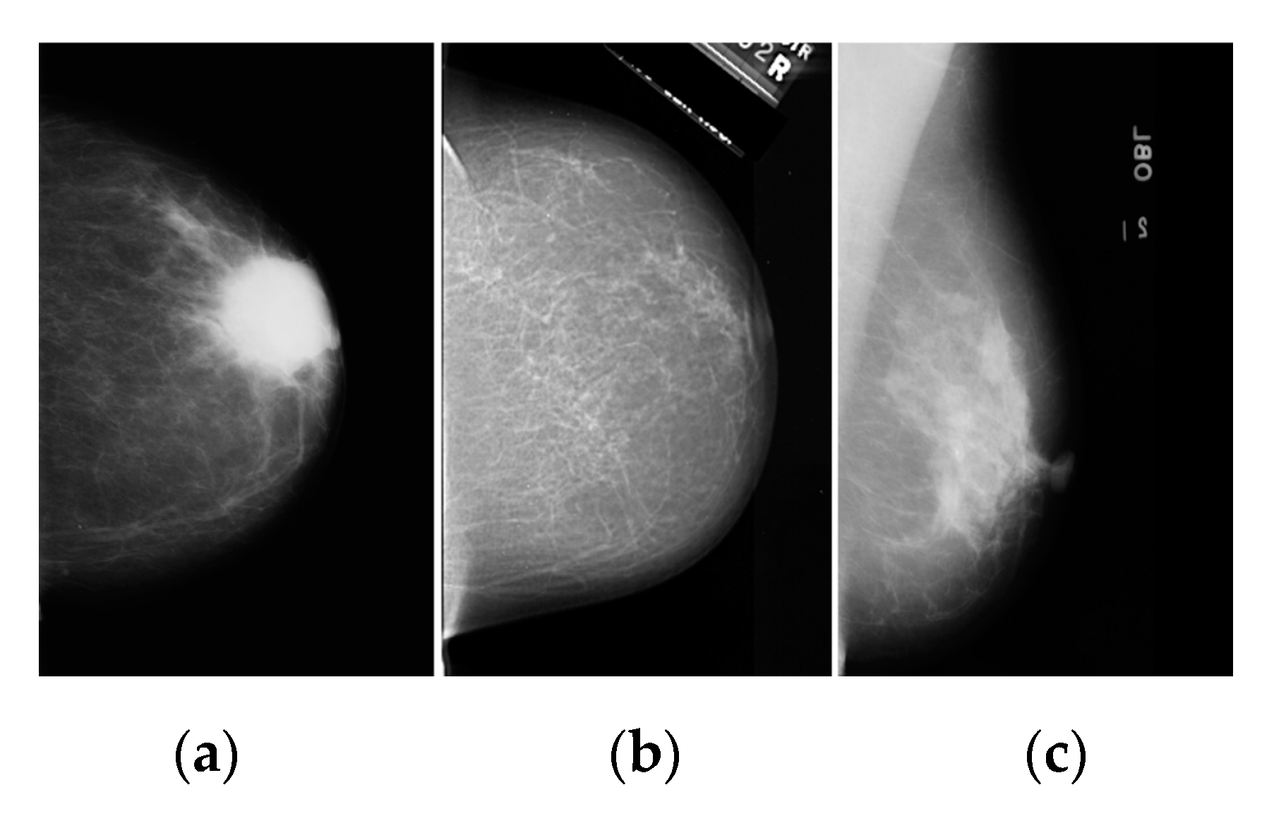 Breast Cancer Detection in Mammogram Images Using K–Means++ Clustering Based on Cuckoo Search ...