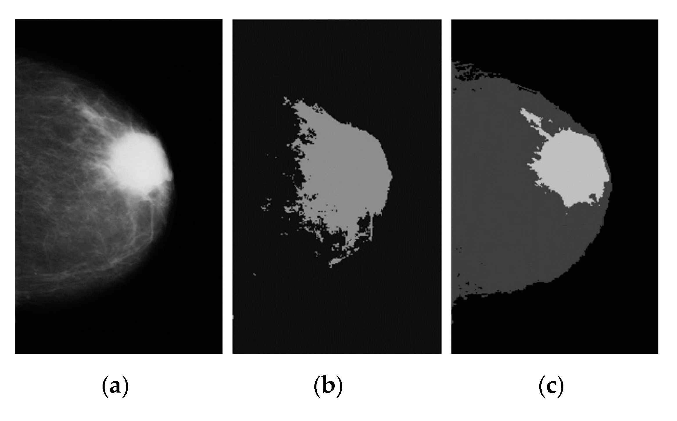 Breast Cancer Detection in Mammogram Images Using K–Means++ Clustering Based on Cuckoo Search ...