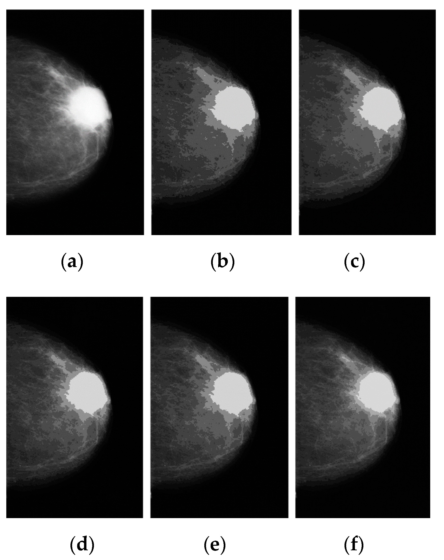 Breast Cancer Detection in Mammogram Images Using K–Means++ Clustering ...