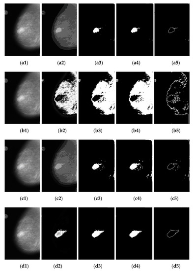 Breast Cancer Detection in Mammogram Images Using K–Means++ Clustering ...