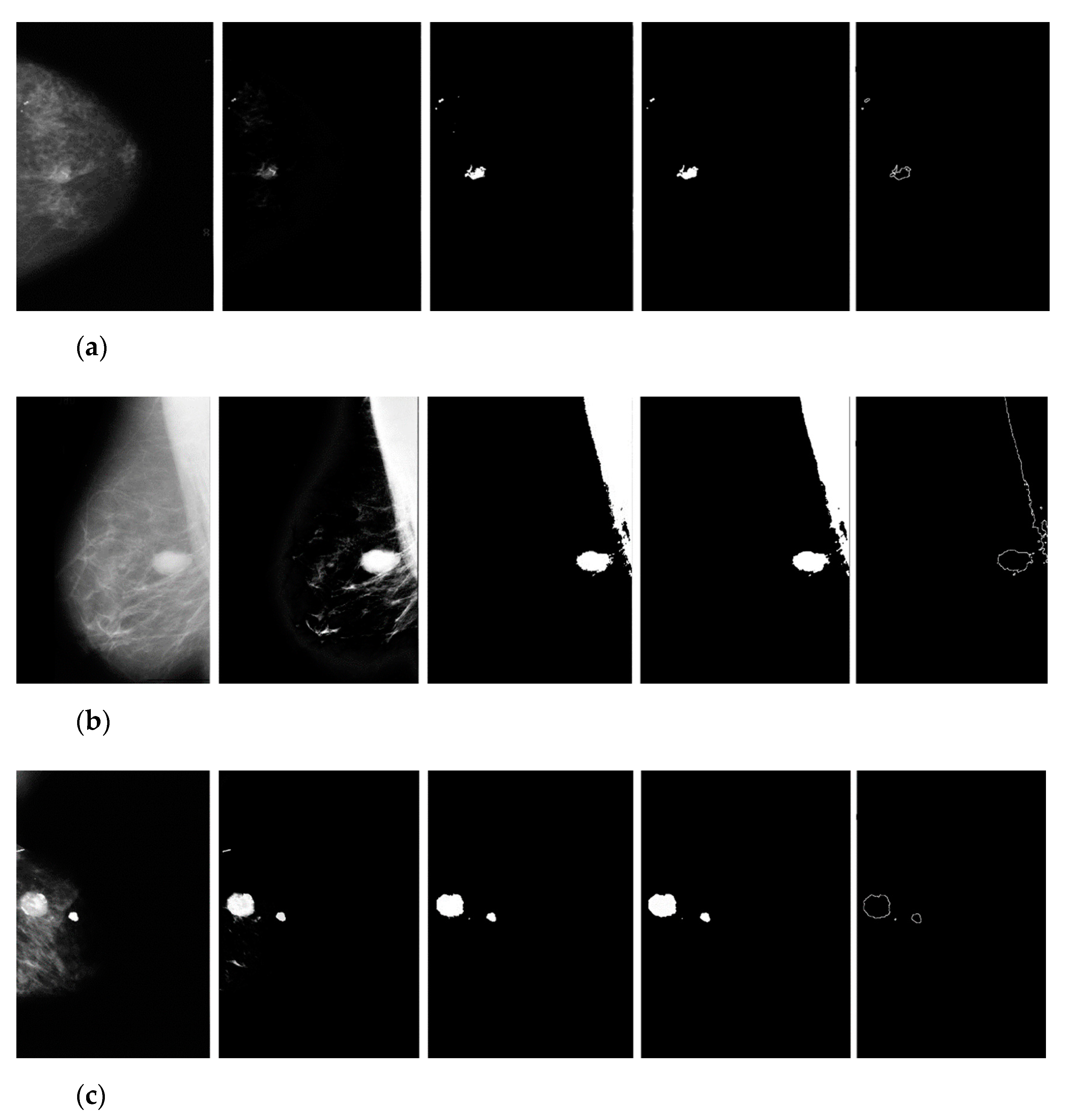 Breast Cancer Detection in Mammogram Images Using K–Means++ Clustering ...