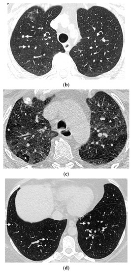 Quantitative Airway Assessment of Diffuse Idiopathic Pulmonary ...