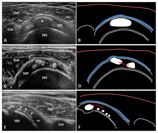 Clinical/Sonographic Assessment and Management of Calcific Tendinopathy ...