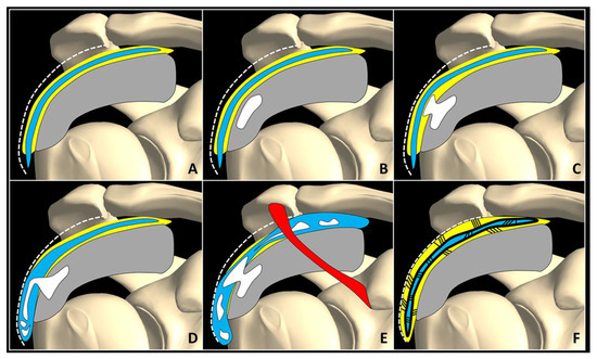 Clinical/Sonographic Assessment and Management of Calcific Tendinopathy ...