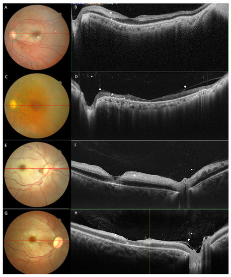 Diagnostics | Free Full-Text | Spectral Domain Optical Coherence ...